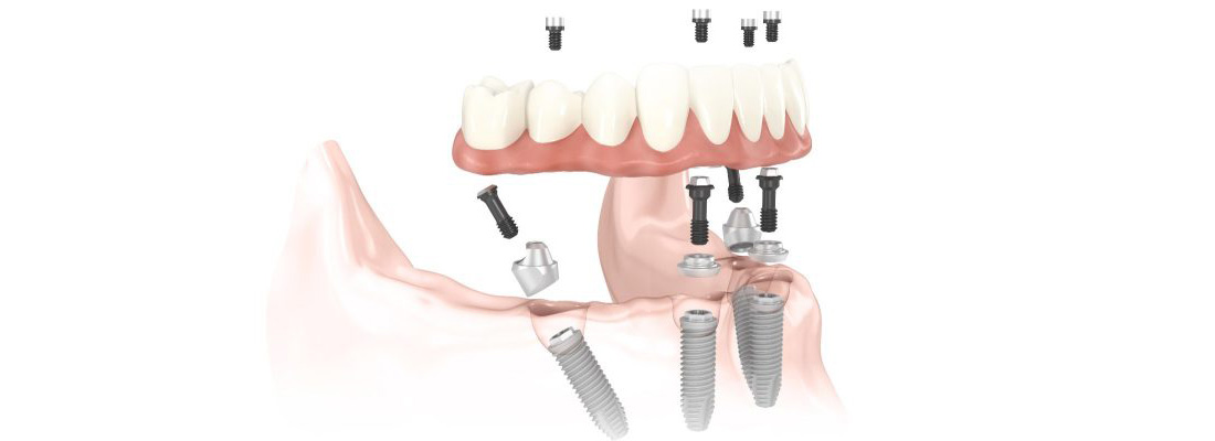 All-On-4 Dental Implants Oral Maxillofacial Surgery | OMS Nashville