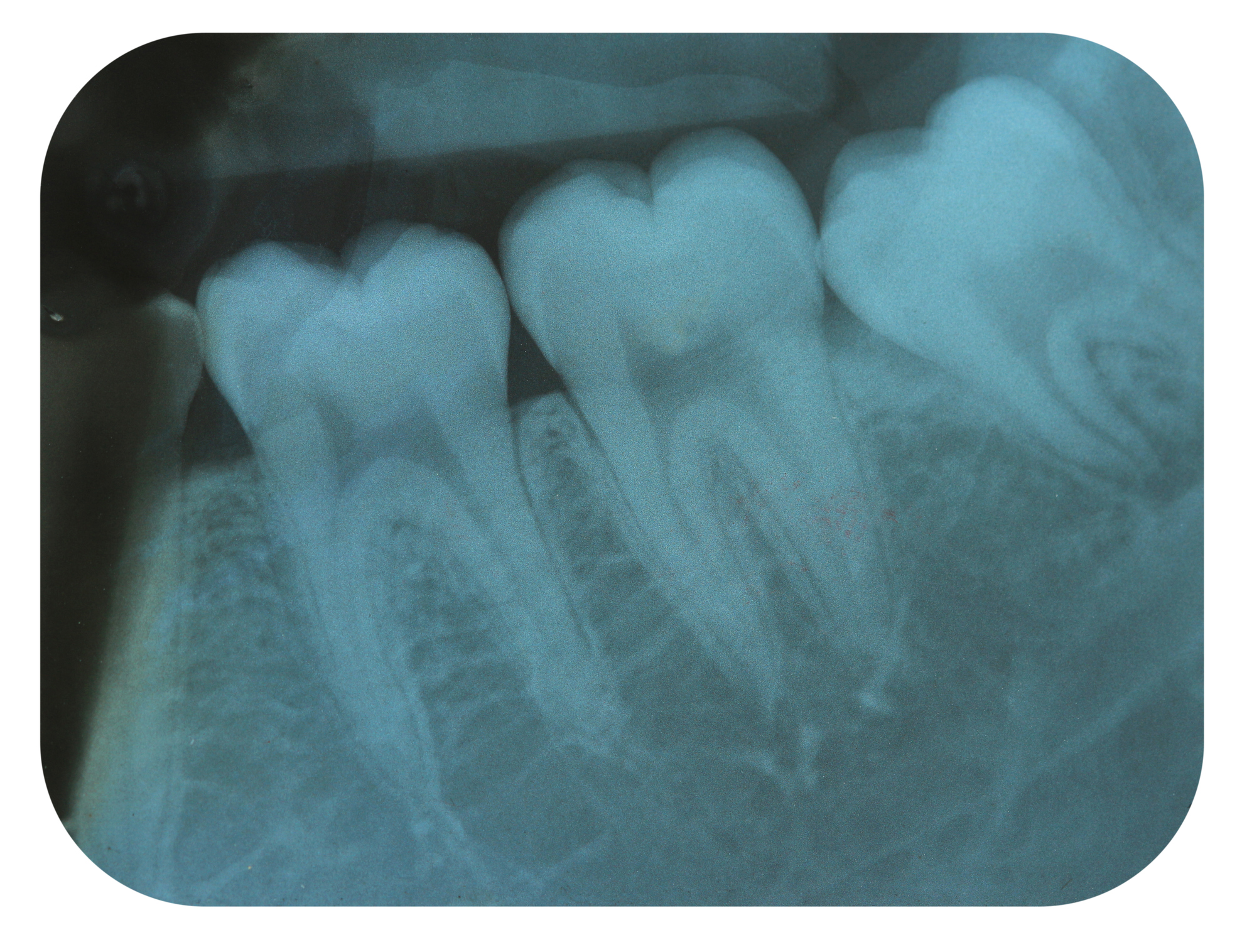 What To Know About Impacted Teeth | OMSNashville TN