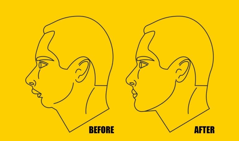 What Is Double Jaw Surgery? | OMSNashville TN